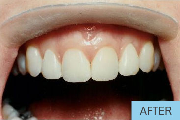 Teeth Recontouring Plano TX | Smile Gallery TLC Dentistry Of Plano