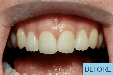 Teeth Recontouring Plano TX | Smile Gallery TLC Dentistry Of Plano